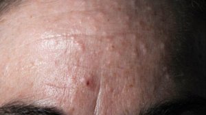 Sebaceous Hyperplasia - Treatment, Photos, Removal, Causes